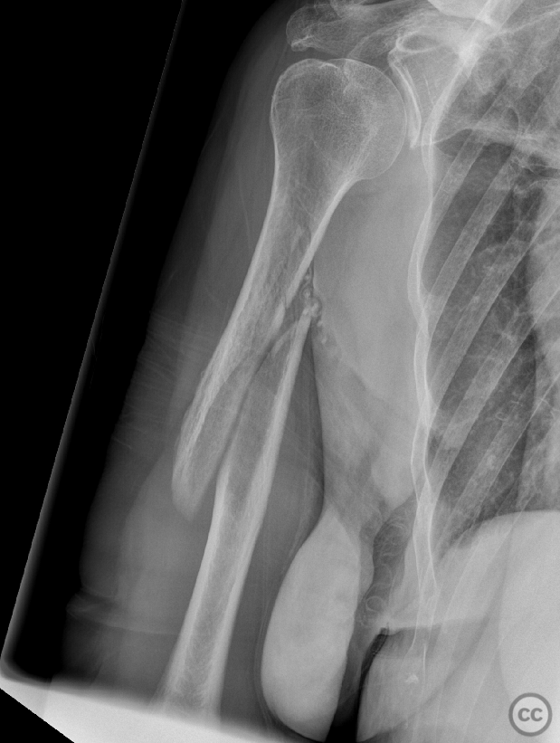 Comminuted spiral midshaft humerus fracture - cerclage and nail