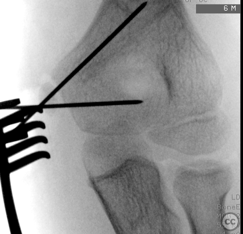 Medial humeral epicondyle avulsion in a 9yo