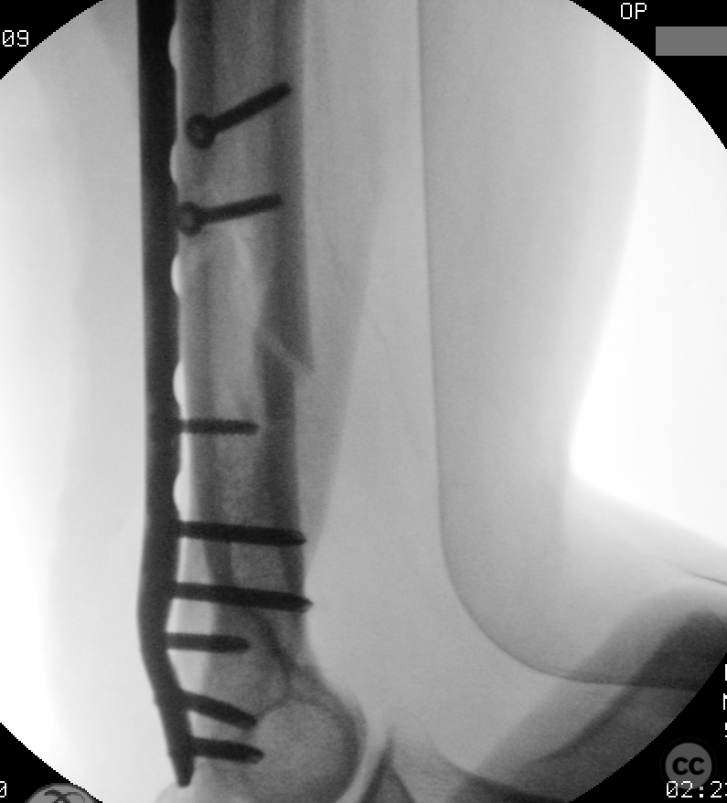 Distal 1/3 humerus shaft fracture - a lateral paratricipital approach ...