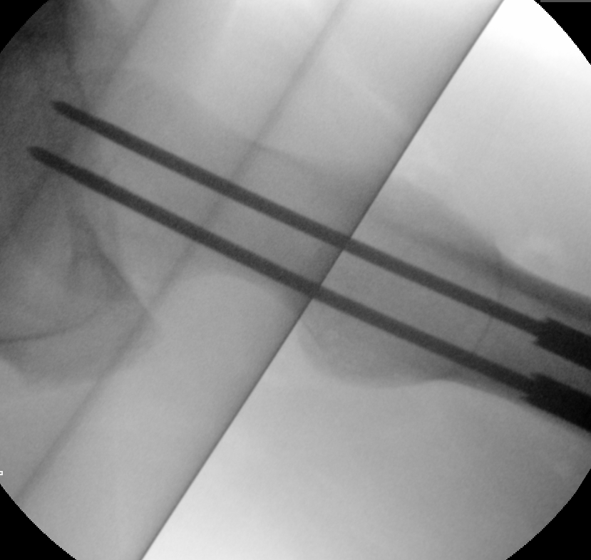 SCFE - Grade I - closed reduction and MIS osteosynthesis