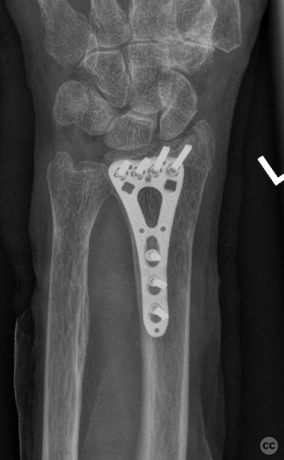 Volar Barton's volar rim fracture distal radius