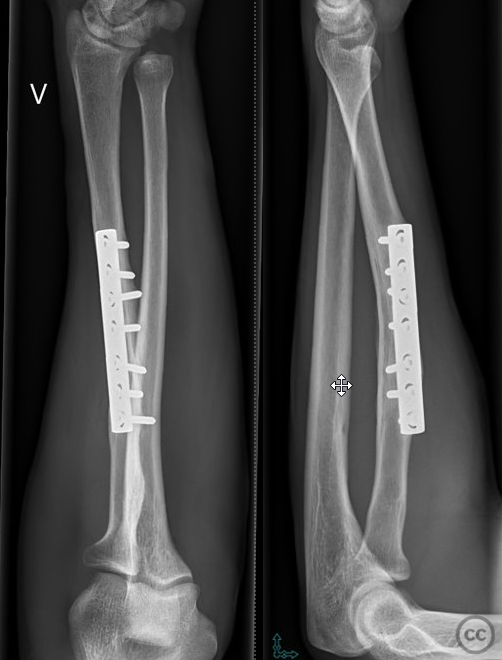 3D printed saw guides and provisional plate for corrective osteotomy of ...
