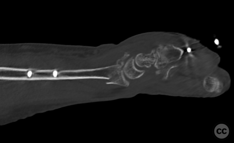 Radiocarpal distraction reduction technique for distal radius fracture