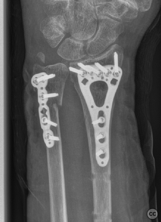 Radiocarpal distraction reduction technique for distal radius fracture