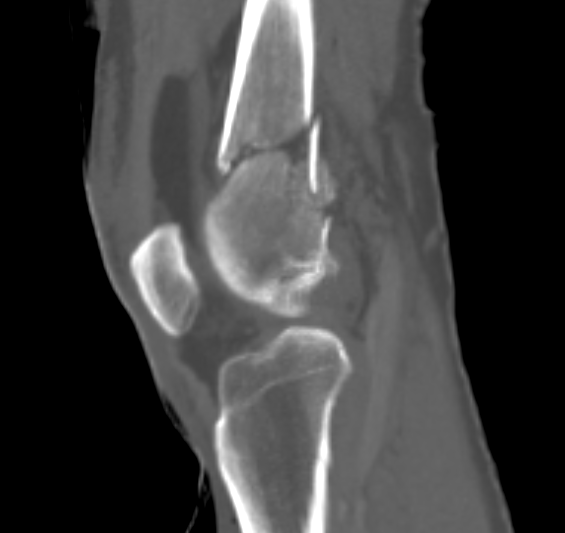Segmental Femur with intercondylar separation
