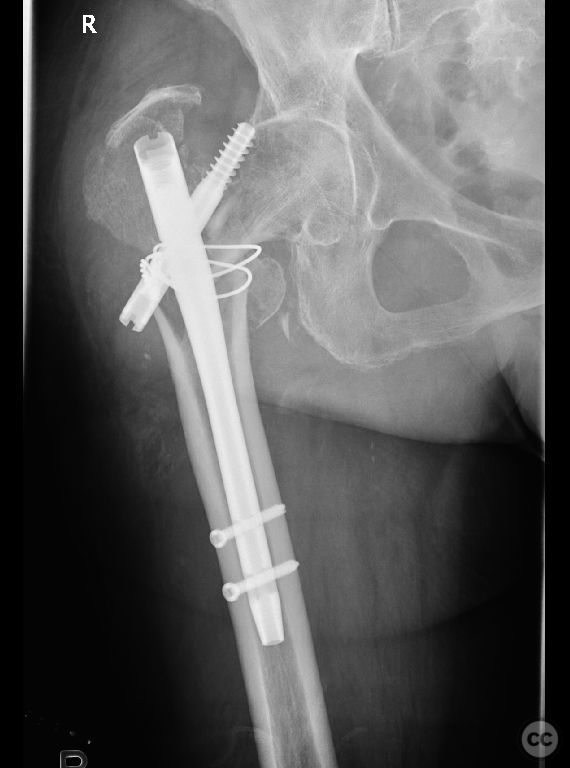 Failure of fixation - Gamma nail cut-out and arthroplasty revision