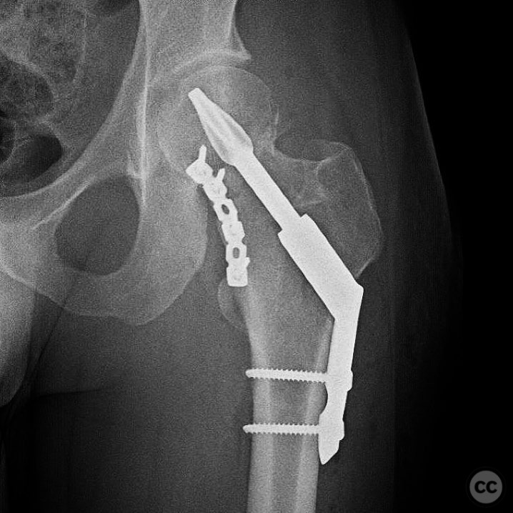 Comminuted Subcapital Femoral Neck Fracture Treated via Heuter Approach