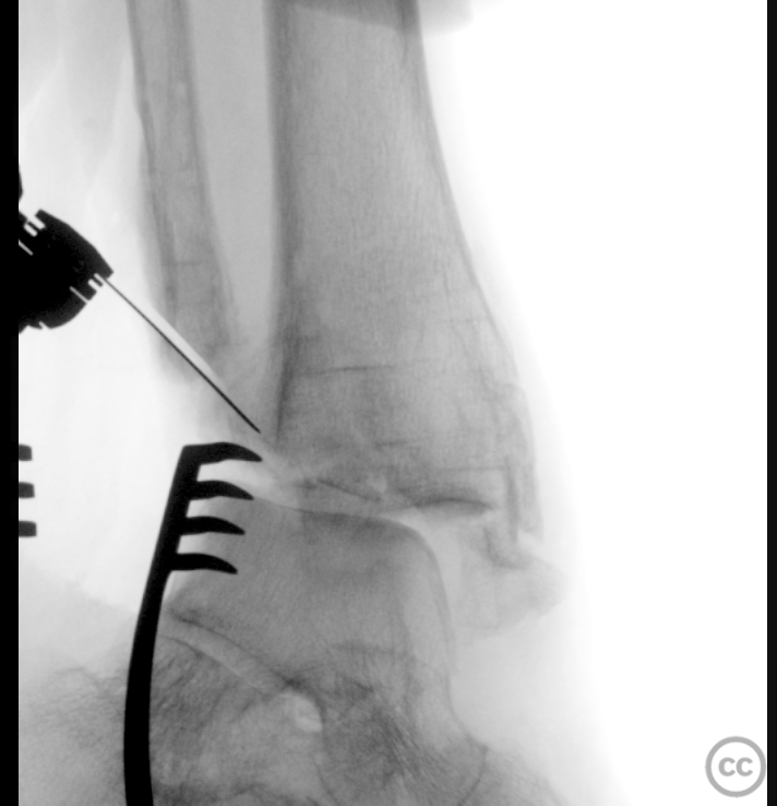 Failed pronation - external rotation (PER) ankle fracture dislocation