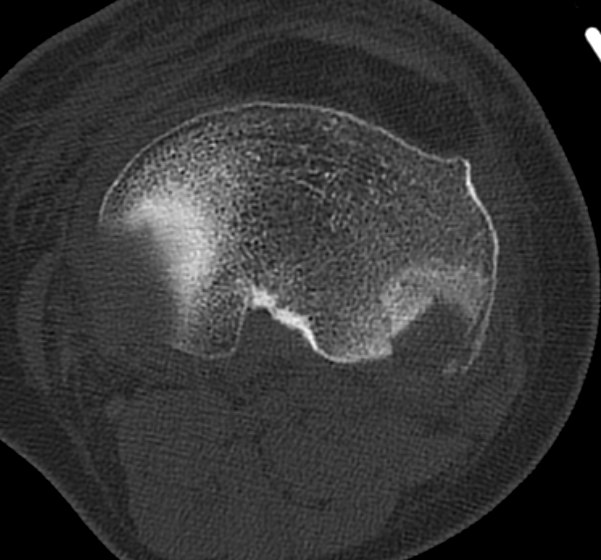 Posterolateral rim-plate Schatzker 2 tibial plateau