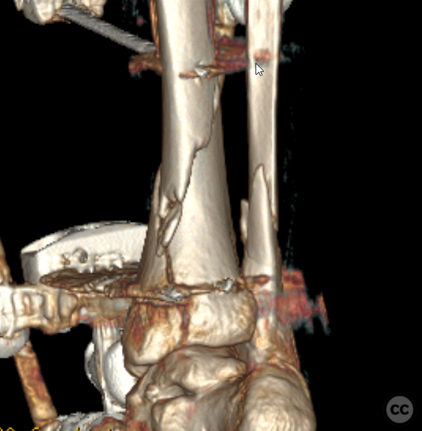 Combined distal 1/3 tibia fracture with SAD bimalleolar ankle fracture