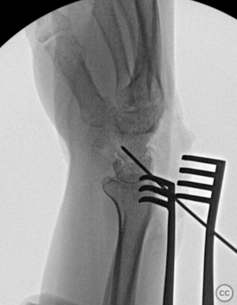 Scaphoidectomy and four corner arthrodesis