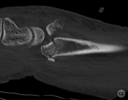 Complex comminuted and impacted distal radius fracture
