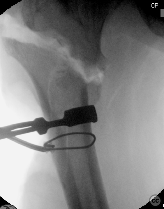 Hardware Failure of Primary Gamma Nail Osteosynthesis in ...