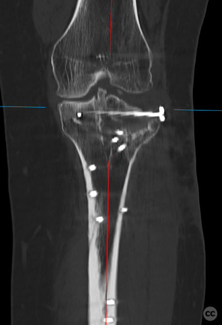 Schatzker 6 tibial plateau with lateral femoral epicondyle osteotomy