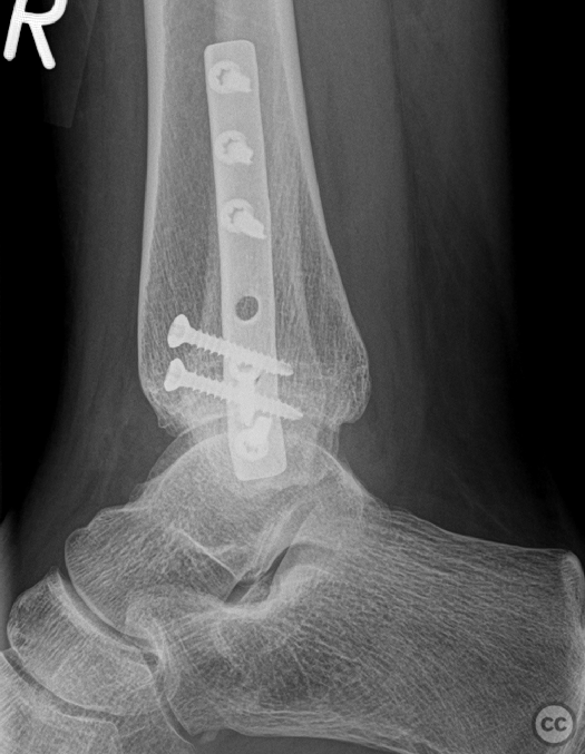 Exploration and Neurolysis for Persistent Neuropathic Pain Post-Weber B ...