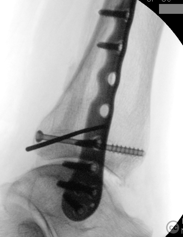 Pronation Abduction (PAb) ankle fracture with Mason 2A lateral plafond ...