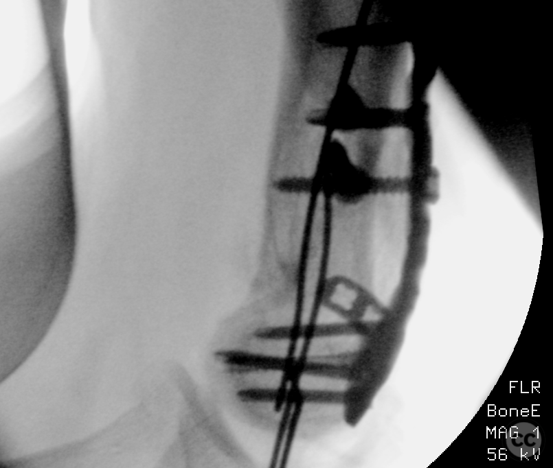 C3 articular humerus fracture with ulnar column vertical shear injury