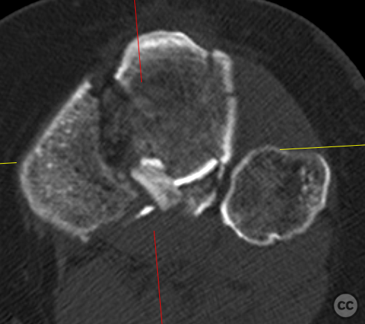 Schatzker 6 tibial plateau with lateral femoral epicondyle osteotomy