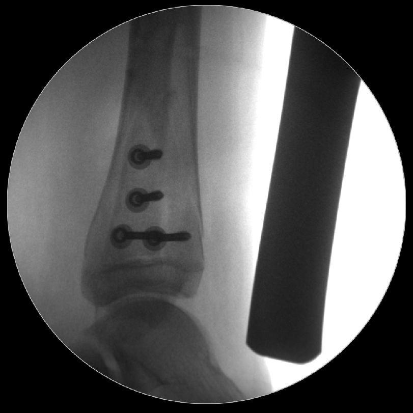 Salter Harris II distal tibia fracture - minimally invasive screw fixation