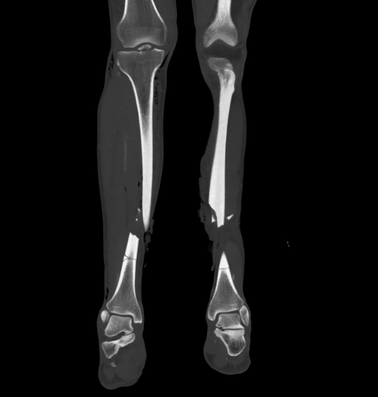 Tibial bony ACL avulsion - open screw osteosynthesis