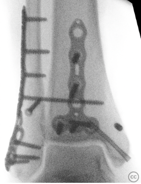Mason and Molloy 2B Posterior Malleolar Fracture. Anterior collicular ...
