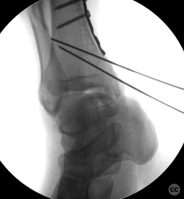 Mason III posterior malleolus fracture dislocation