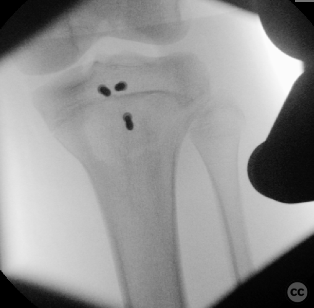 Tibial tubercle fracture - Type III