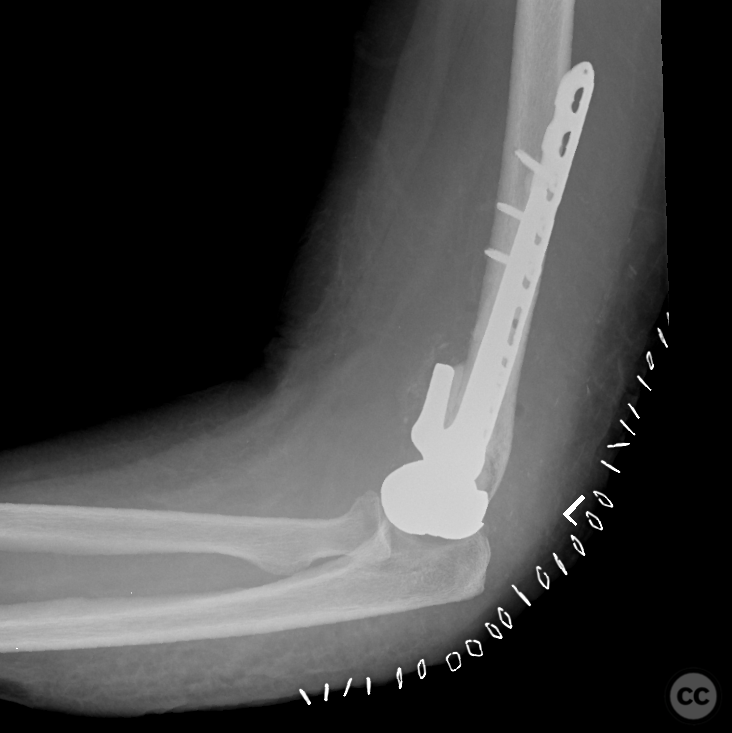 Fracture hemiarthroplasty distal humerus