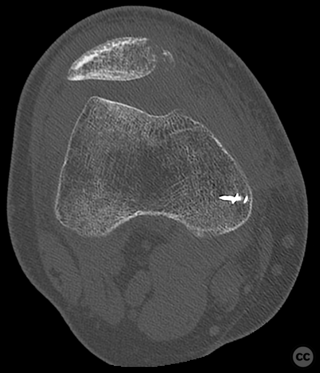 Destructive osteochondral fracture of the lateral femoral condyle ...
