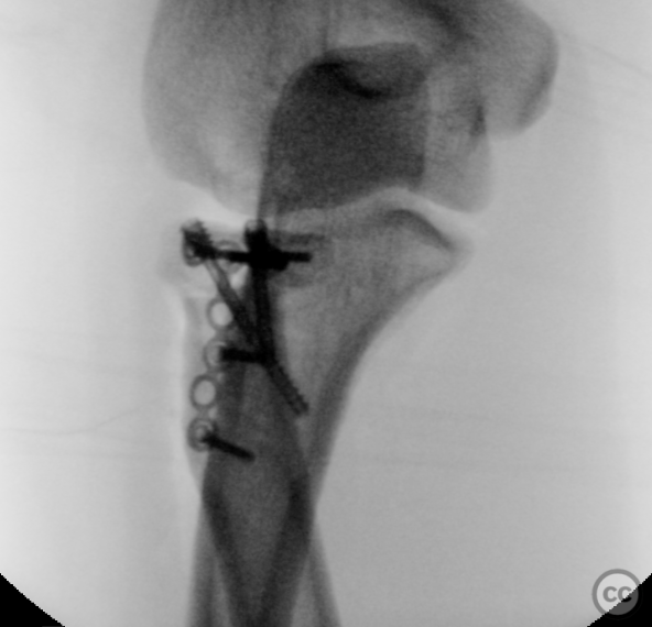 Mason III radial head fracture - Boyd's approach