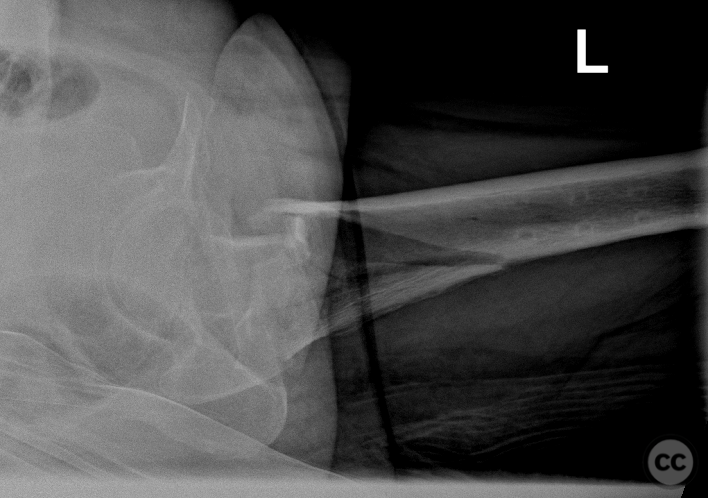 Multifragment intertrochanteric femur fracture with subtrochanteric ...