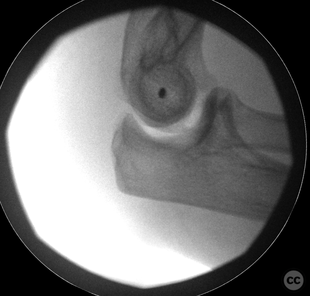 PMRI following elbow dislocation with pMCL insufficiency