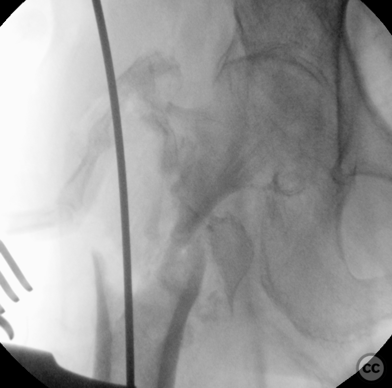 Failure of fixation - Gamma nail cut-out and arthroplasty revision