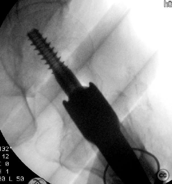 Classical intertrochanteric fracture with reverse oblique extension