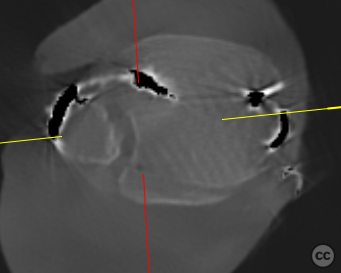 Failed pronation - external rotation (PER) ankle fracture dislocation