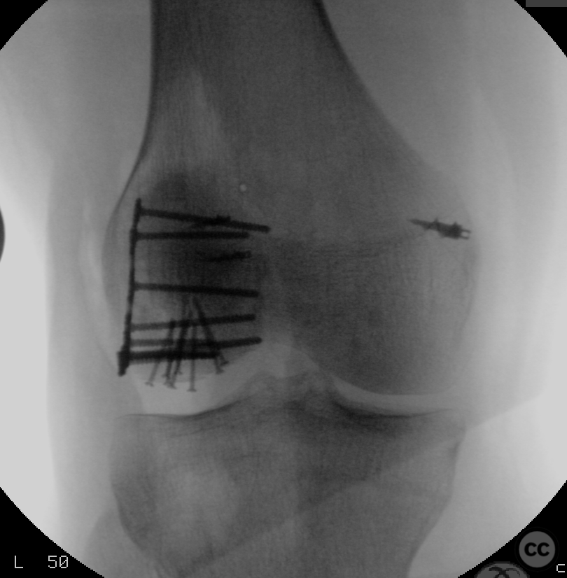 Destructive osteochondral fracture of the lateral femoral condyle ...