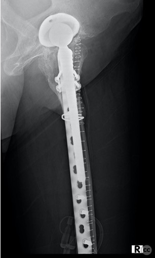 Periprosthetic fracture