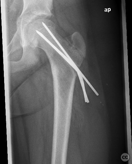 SCFE - longitudinal images over 6 years: 10-16years old