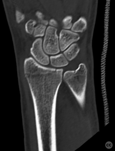 Operative Management of Chauffeur's Fracture with Intraarticular ...