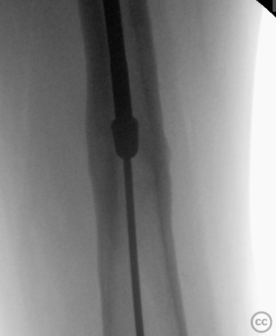 Multifragment intertrochanteric femur fracture with subtrochanteric ...
