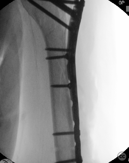 Anterolateral Helix plate - segmental proximal humerus fracture