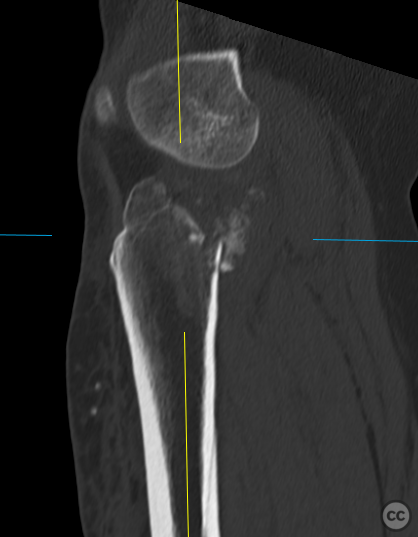 Schatzker 6 tibial plateau with lateral femoral epicondyle osteotomy