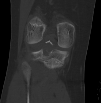 Tibial bony PCL Avulsion - open screw osteosynthesis
