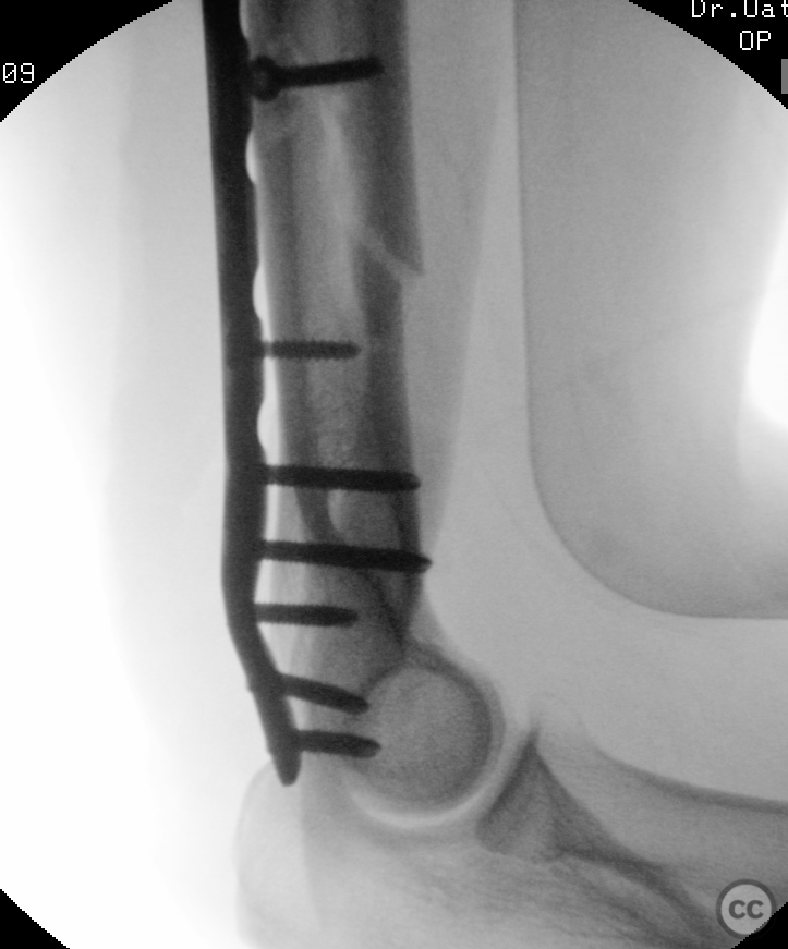 Distal 1/3 humerus shaft fracture - a lateral paratricipital approach ...