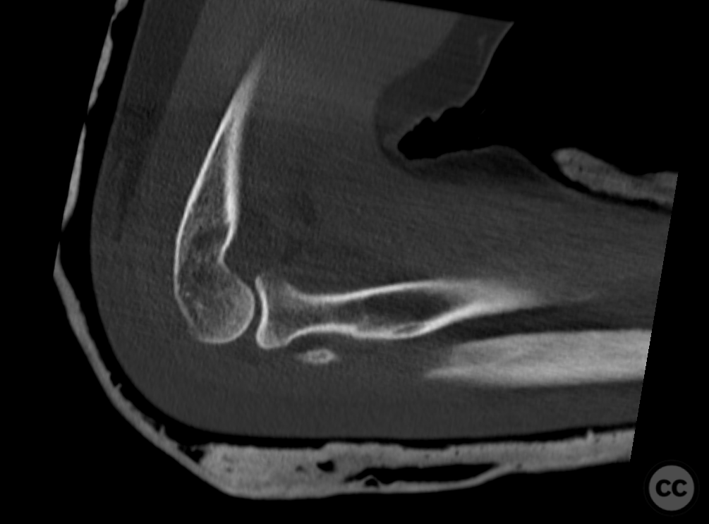 PMRI following elbow dislocation with pMCL insufficiency