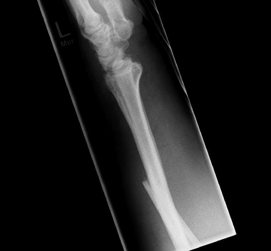 Essex-Lopresti fracture-dislocation