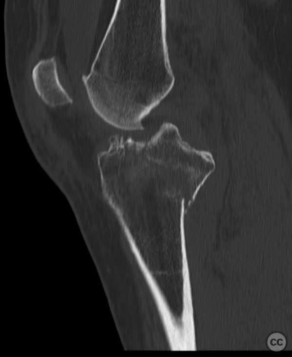 Posterolateral approach to the tibial plateau with femoral epicondylar ...