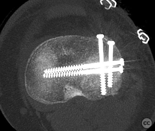 Jail-screw fixation posterolateral plateau impression fracture