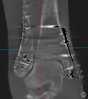 Failed pronation - external rotation (PER) ankle fracture dislocation