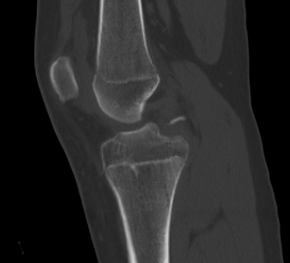 Tibial bony PCL Avulsion - open screw osteosynthesis